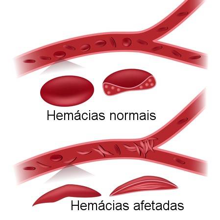 Você sabe o que é anemia falciforme? Aprenda aqui! - Noeh